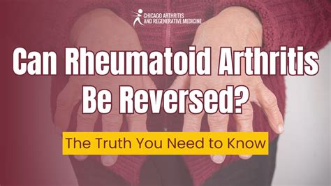 Can Rheumatoid Arthritis Be Reversed The Truth You Need To Know