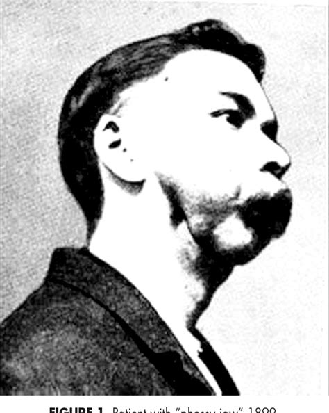 Figure 1 From Uncovering The Cause Of Phossy Jaw Circa 1858 To 1906