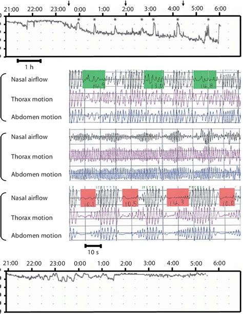 Central Apnea Oxygen Saturation At Gustavo Gomez Blog