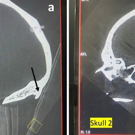 External Occipital Protuberance Classification A Type 1 Smooth Or Download Scientific Diagram