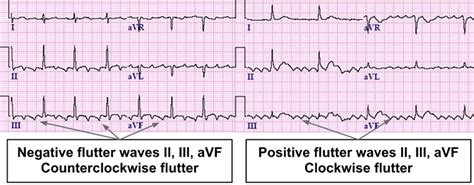 Image Result For Atypical Atrial Flutter Atrial Flutter Flutter