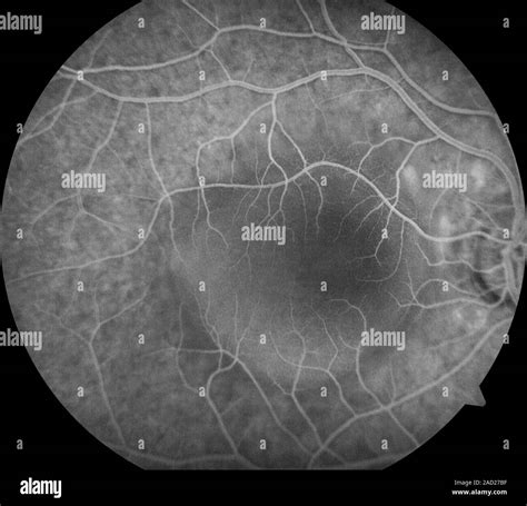 Retinal Pigment Epithelial Detachment Fundus Fluorescein Angiography