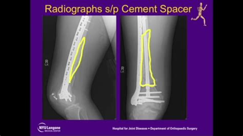 Treatment Of Segmental Bone Defect Using The Induced Membrane Technique The Masquelet Procedure