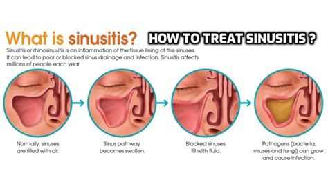 How To Have A Healthy Life What Is The Best Way For Treating My Sinus