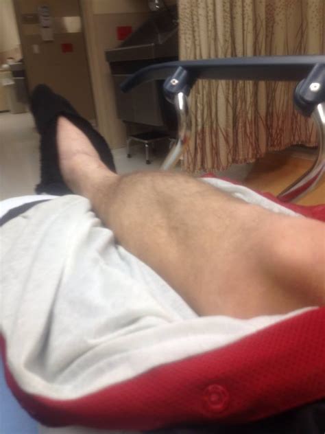 Re Broke Tib Fib Moto Related Motocross Forums Message Boards Vital MX