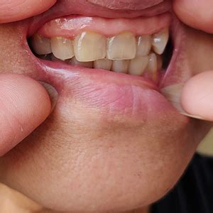 White Spots On Gums From Smoking