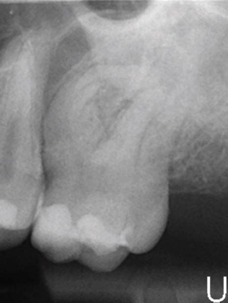 Endodontic Assessment Complexity Diagnosis And Treatment Planning Pmc
