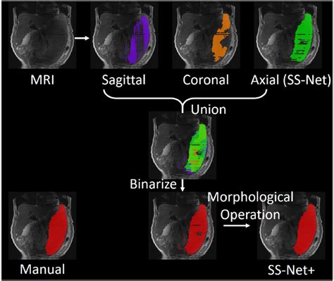 Splenomegaly Segmentation On Multi Modal Mri Using Deep Convolutional Networks Pmc