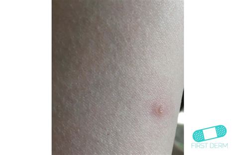 Insect Bite Online Dermatology