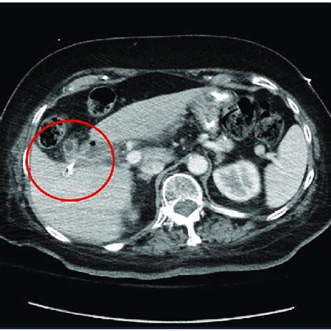 Anterograde Percutaneous Cholangiogram Showing An Hepaticojejunostomy Download Scientific