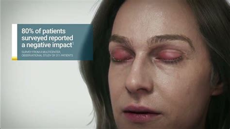 An Overview Of Demodex Blepharitis Youtube