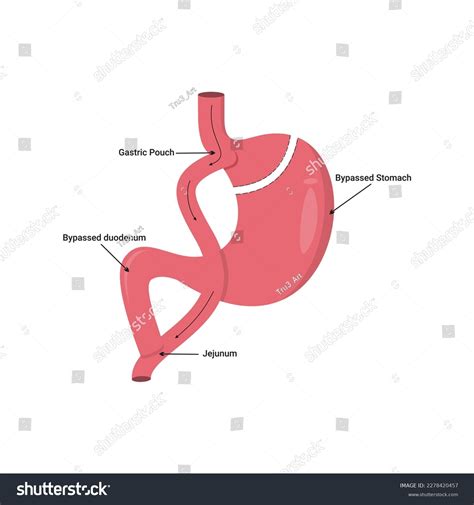 Gastric Bypass Surgery Vector Illustration Stock Vector Royalty Free Gastric Bypass Surgery Vector Illustration Stock Vector Royalty Free