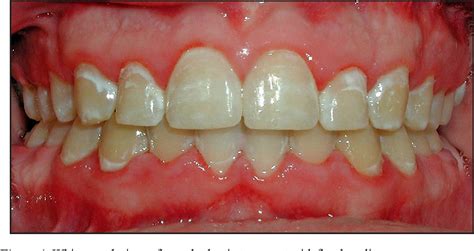 Figure 1 From Prevention And Treatment Of White Spot Lesions During And