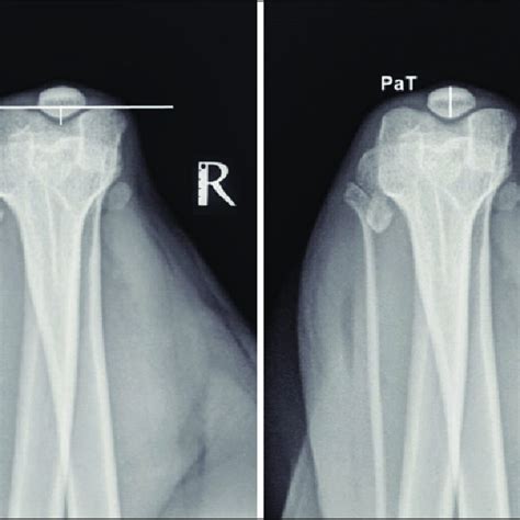 Left Measurement Of Trochlear Depth Td [20] Right Measurement Of Download Scientific