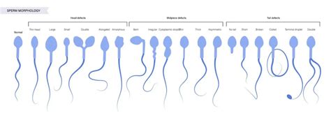 Sperm Morphology And Fertility Conceive Plus®
