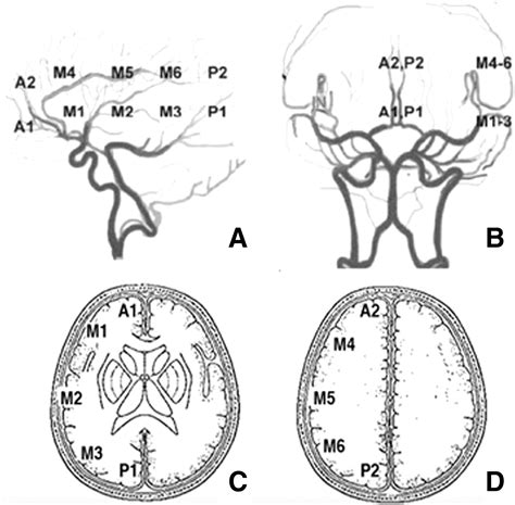 English Reperfusion Scaleticistrokeendovascular