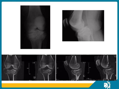Proximal Tibial Fracture Ppt