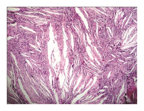 A Ct Scan Revealed A Well Defined Radiolucency 30 × 14 Mm In Size Download Scientific