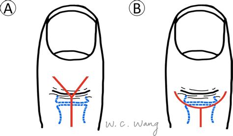 Modified Skin Incision A Traditional Y Incision B Modified Y