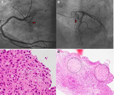 Undifferentiated Pleomorphic Cardiac Sarcoma A Rare And Often Fatal