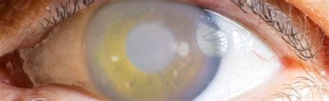 Untreated Glaucoma Can Lead To Permanent Blindness