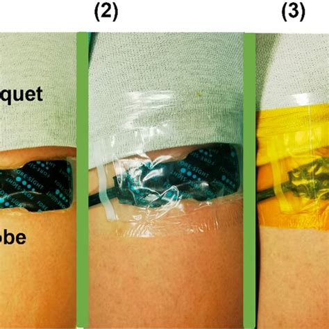Example Case Of How The Probe Was Placed And Secured 1 A Probe Download Scientific Diagram