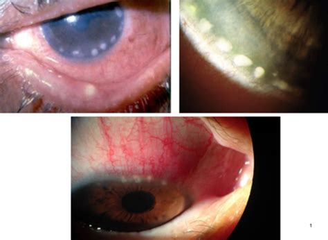 Ant Seg 10 Inflammatory Corneal Disorders Flashcards Quizlet