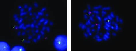 Abnormal Signal Patterns In FISH Analysis Download Scientific Diagram