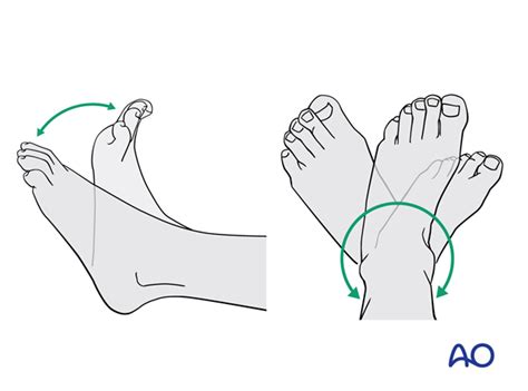 Closed Reduction Casting For Epiphysiolysis With Metaphyseal Wedge Salter Harris Ii