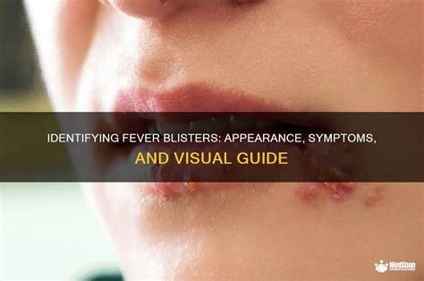 Identifying Fever Blisters Appearance Symptoms And Visual Guide