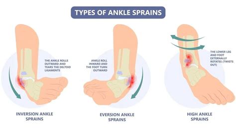Ankle Injuries Colac Physiotherapist Grant Brauer Has You Covered