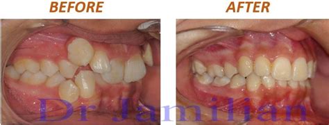 Dr Jamilian Orthodontic Clinic Case Reports Class Ii Div 2