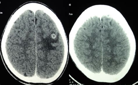 Computed Tomography Showing A Single Cerebral Parenchymal Calcification Download Scientific