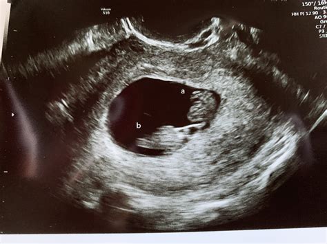 The Ultrasound Thread Page 3 The Bump