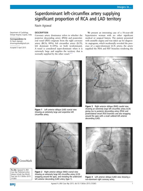 Pdf Superdominant Left Circumflex Artery Supplying Significant Proportion Of Rca And Lad Territory