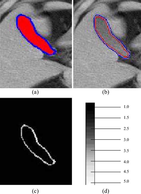 The Semi Automated Contouring Of The Gallbladder On Ct Image Is Shown