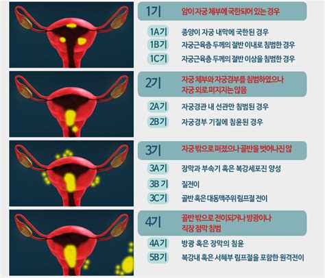 자궁내막암치료 메르스와 암환자치료의 우려 면역력이 해답 네이버 블로그