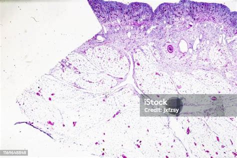 Granulation Tissue Human Pathological Sample Under Microscope Stock