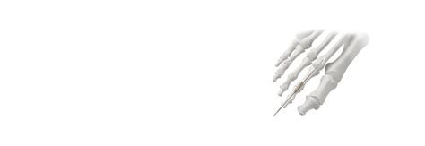 Hammertoe Peek Fixation System Treace Surgical Solutions