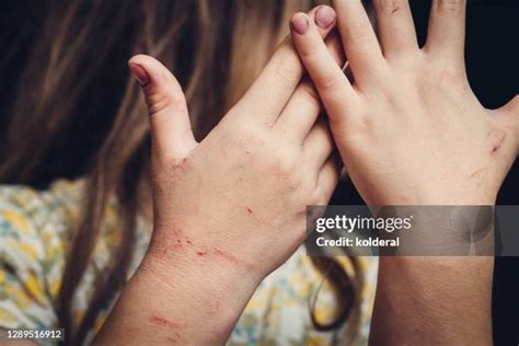 Scratch Marks On Face