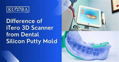Difference Of Itero 3d Scanner From Dental Silicon Putty Mold Kumra Orthodontics