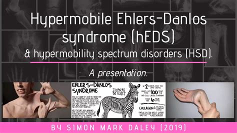 Hypermobile Ehlers Danlos Syndrome And Hypermobility Spectrum Disorders A Presentation Pdf