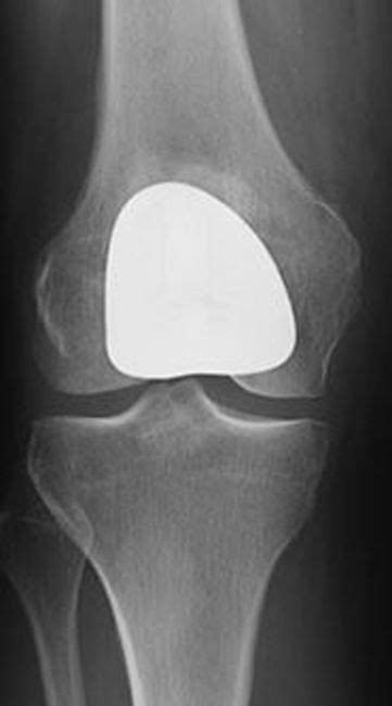 Patellofemoral Replacement Orthoinfo Aaos