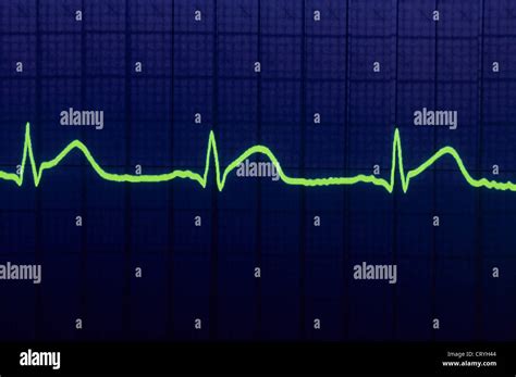 Heart Attack Ecg