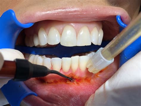 Curso De Periodoncia Y Nanotecnología Láser Beide
