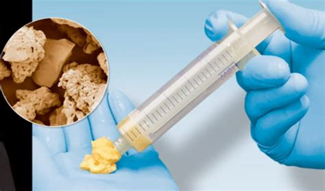 Guided Bone Regeneration Gbr Part 3 Allogenic And Xenogeneic And Alloplastic Transplants