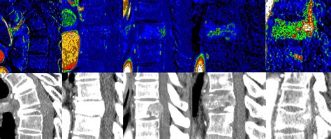 Association Of Ct Dsa Vascular Assessment And Perioperative Outcomes In Metastatic Spinal