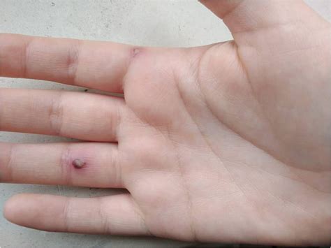 Gonococcal Infection Symptoms