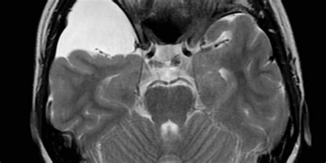 Arachnoid Cysts Neuropedia