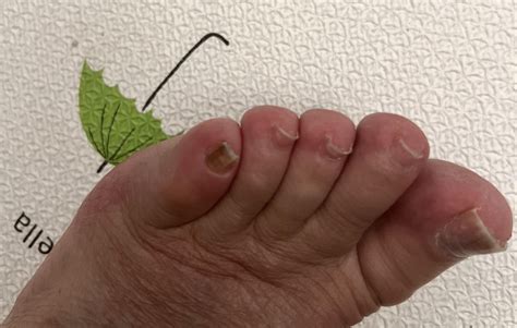 Subungual Melanoma Rmelanoma